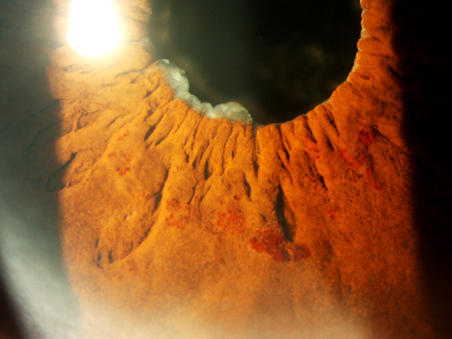 Case of the month (October 2020) - Οφθαλμολογικό Κέντρο Ophthalmica