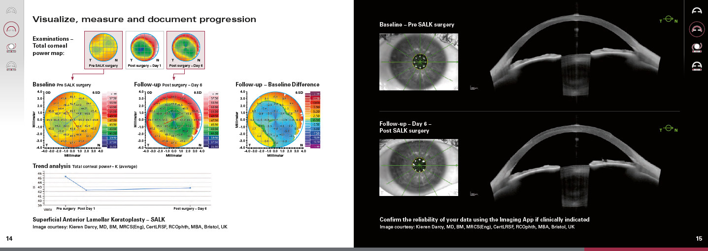 Το 1ο διαγνωστικό σύστημα Heidelberg Anterion στην Ελλάδα στο ...