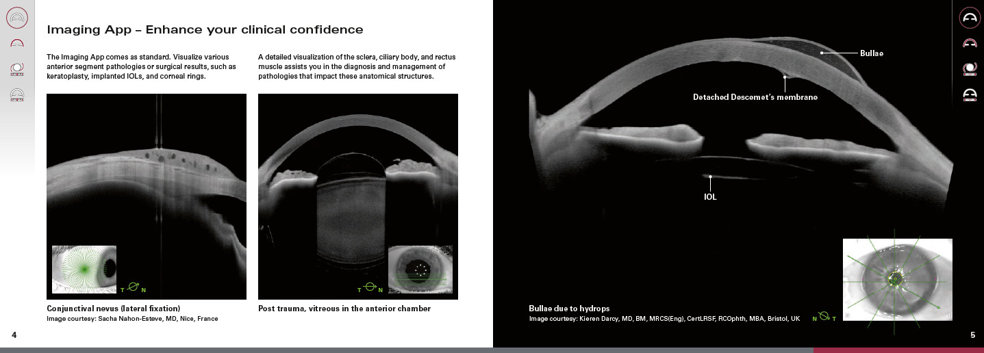 Το 1ο διαγνωστικό σύστημα Heidelberg Anterion στην Ελλάδα στο ...