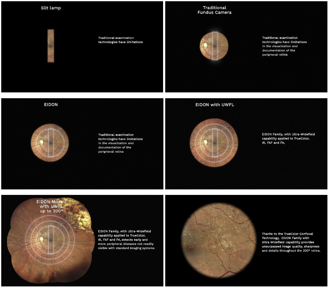 Το iCare ULTRA-Widefield (UWFL) module της φωτογράφησης βυθού Centervue ...