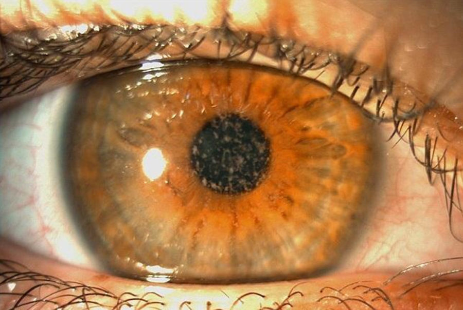 Case of the month (Feb 2023) | Οφθαλμολογικό Κέντρο Ophthalmica