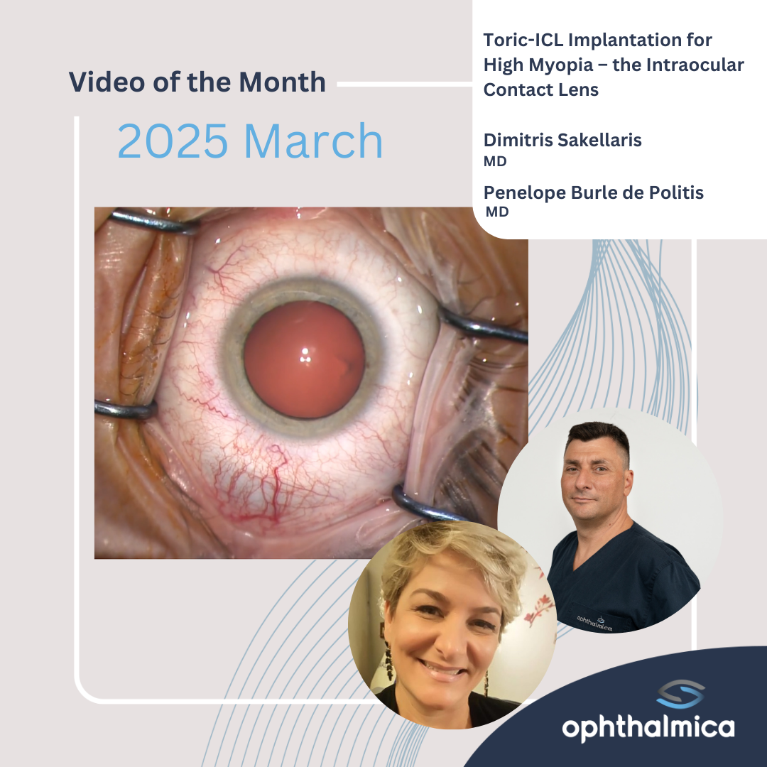 Video of the month | March 2025 | Toric-ICL Implantation for High ...