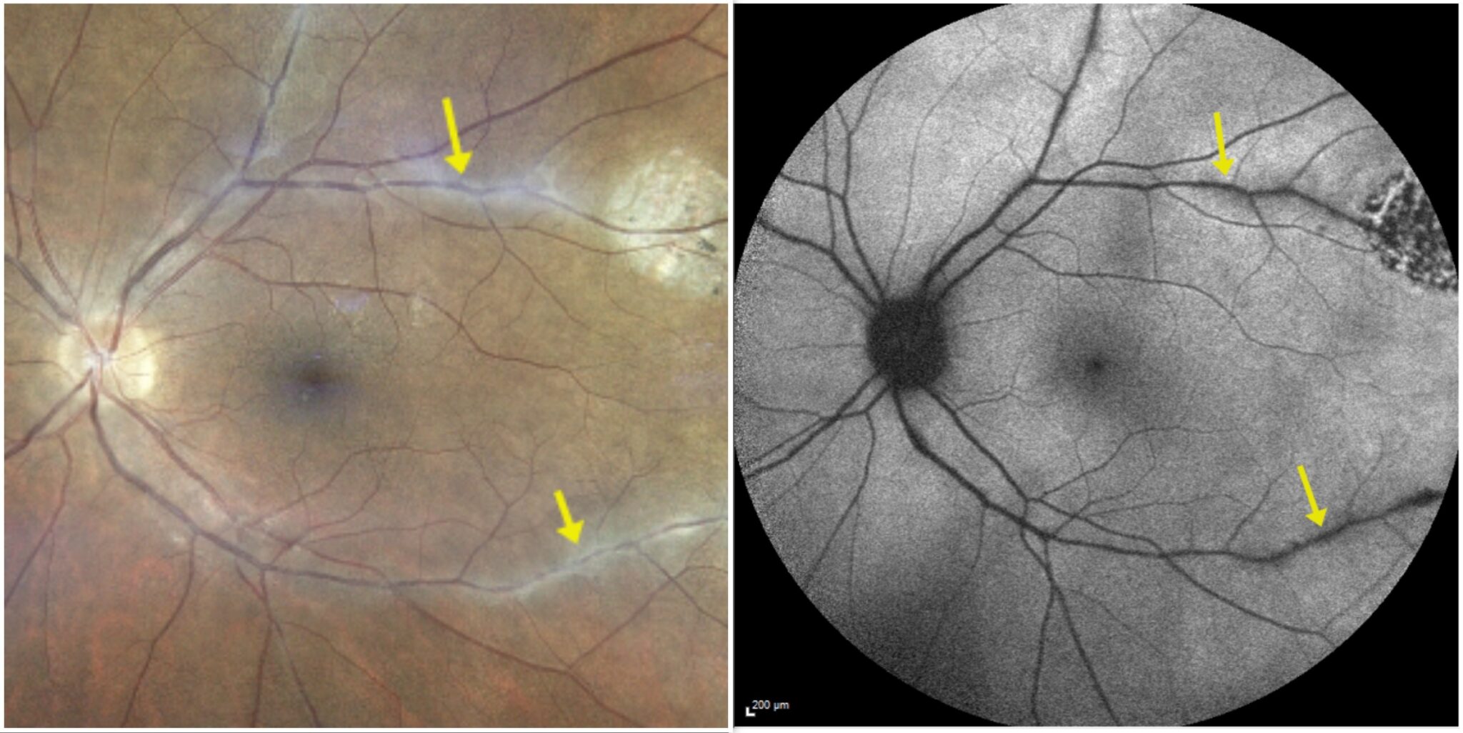 Case of the month (April 2025) - Οφθαλμολογικό Κέντρο Ophthalmica